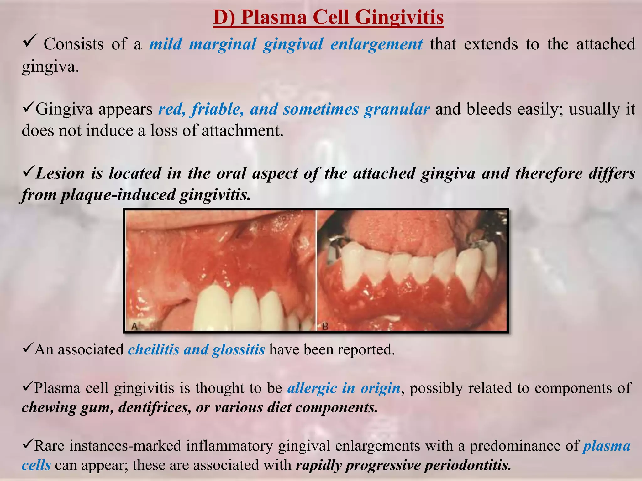 Gingival enlargment and its treatment | PPTX