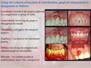 Gingival enlargment and its treatment | PPTX