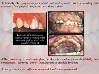 Gingival enlargment and its treatment | PPTX