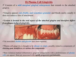 Plasma Cell Gingivitis