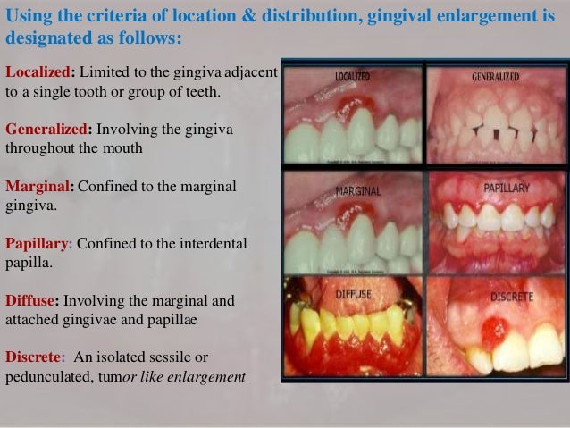 Gingival enlargment and its treatment