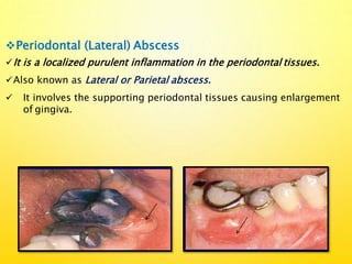 Gingival enlrgment | PPTX