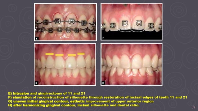 Gingival esthetics | PPTX | Dental Health | Diseases and Conditions