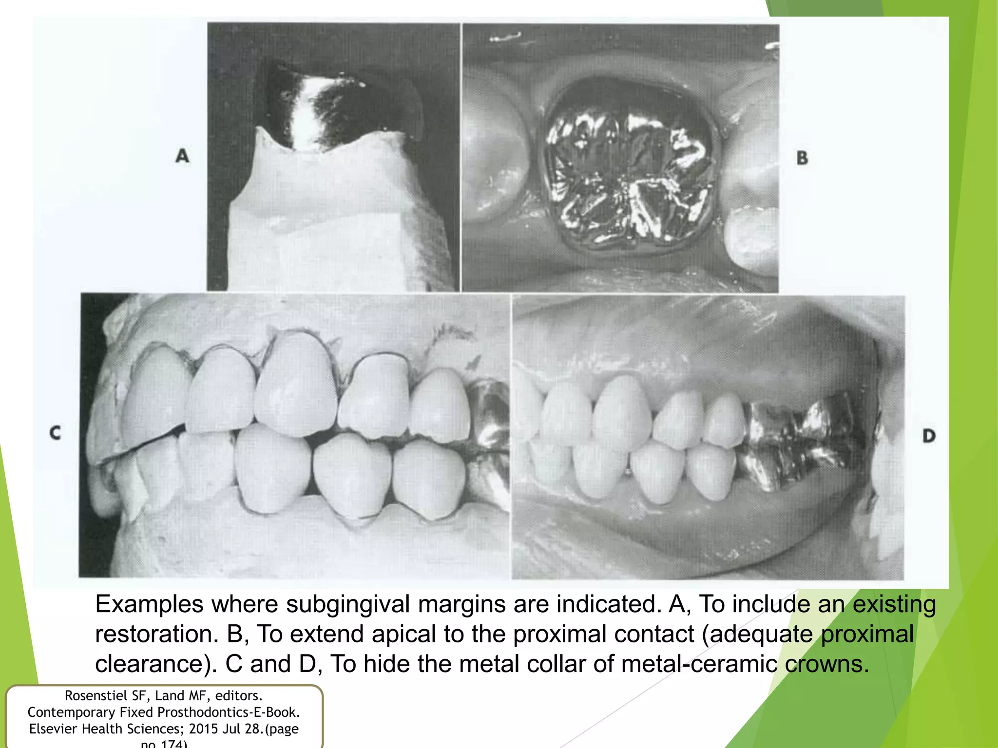 Gingival finish lines in fixed prosthodontics | PPT