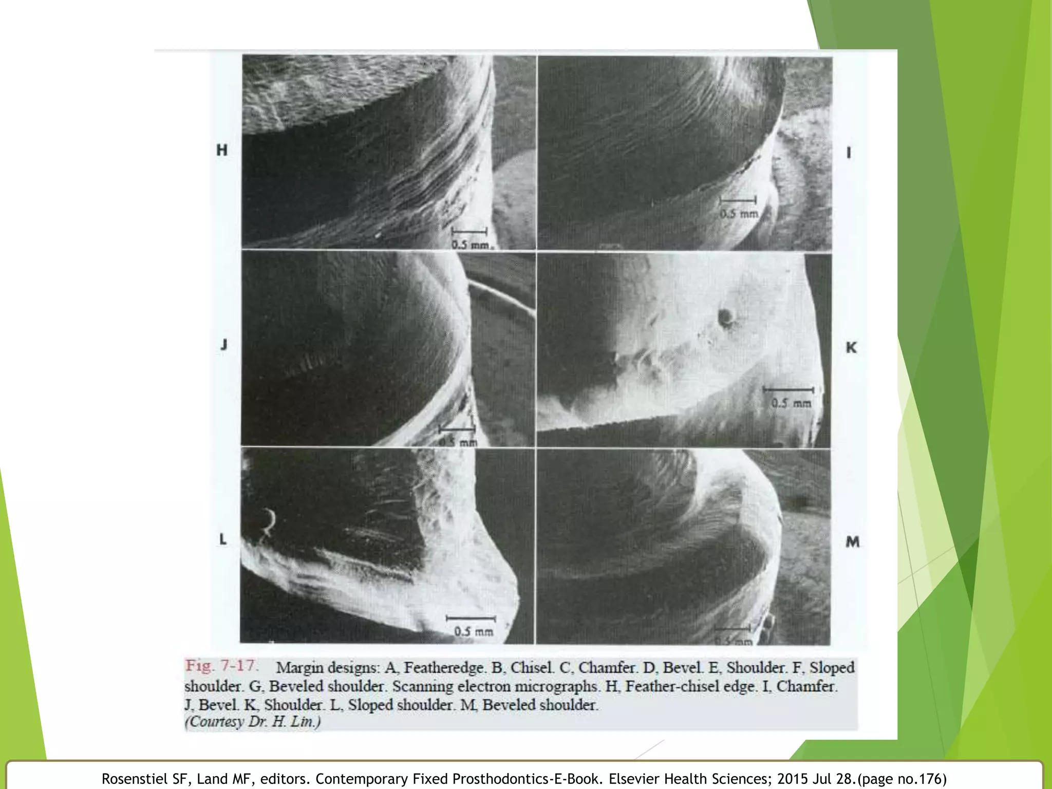 Gingival finish lines in fixed prosthodontics | PPT