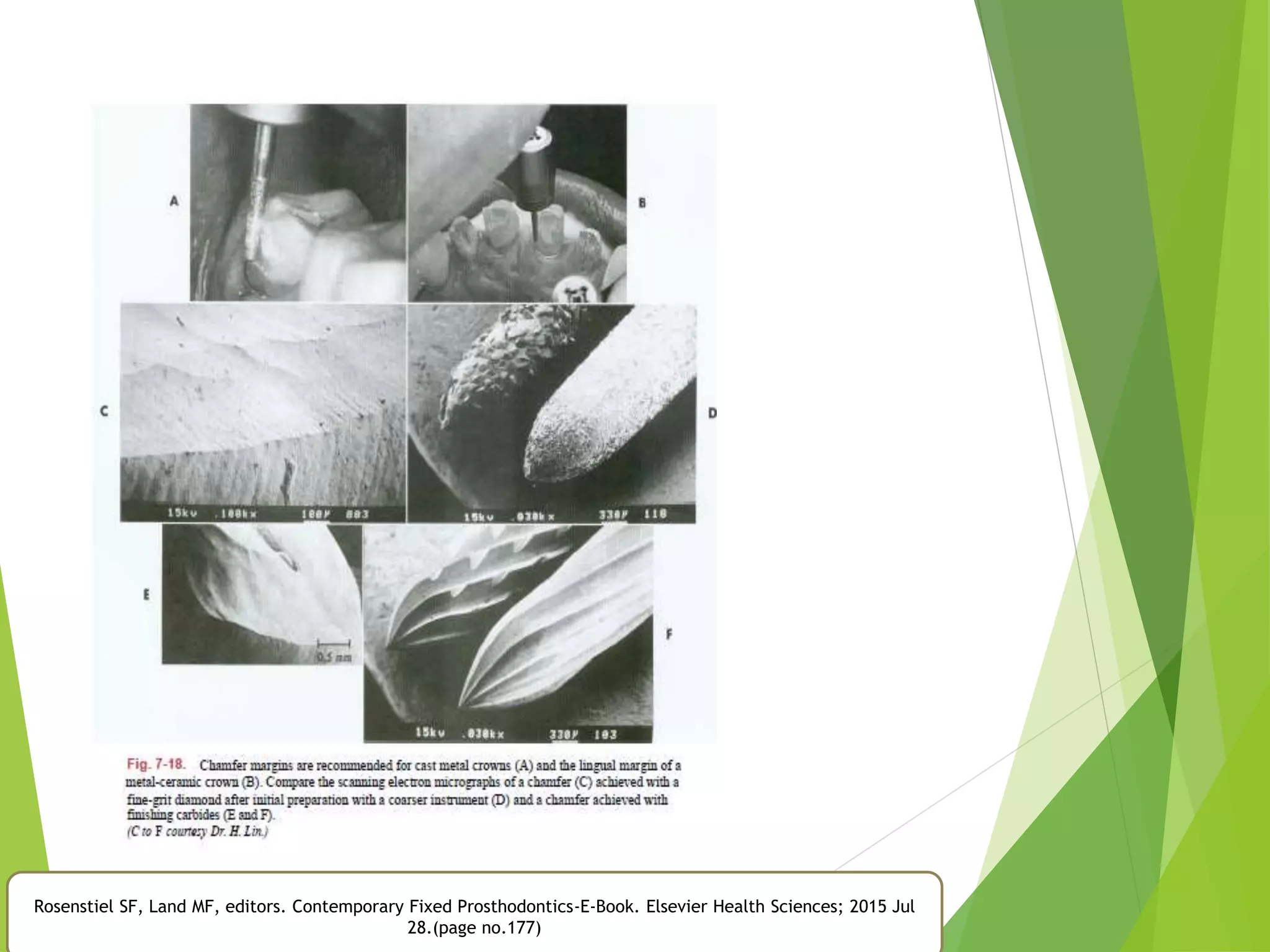 Gingival finish lines in fixed prosthodontics | PPT
