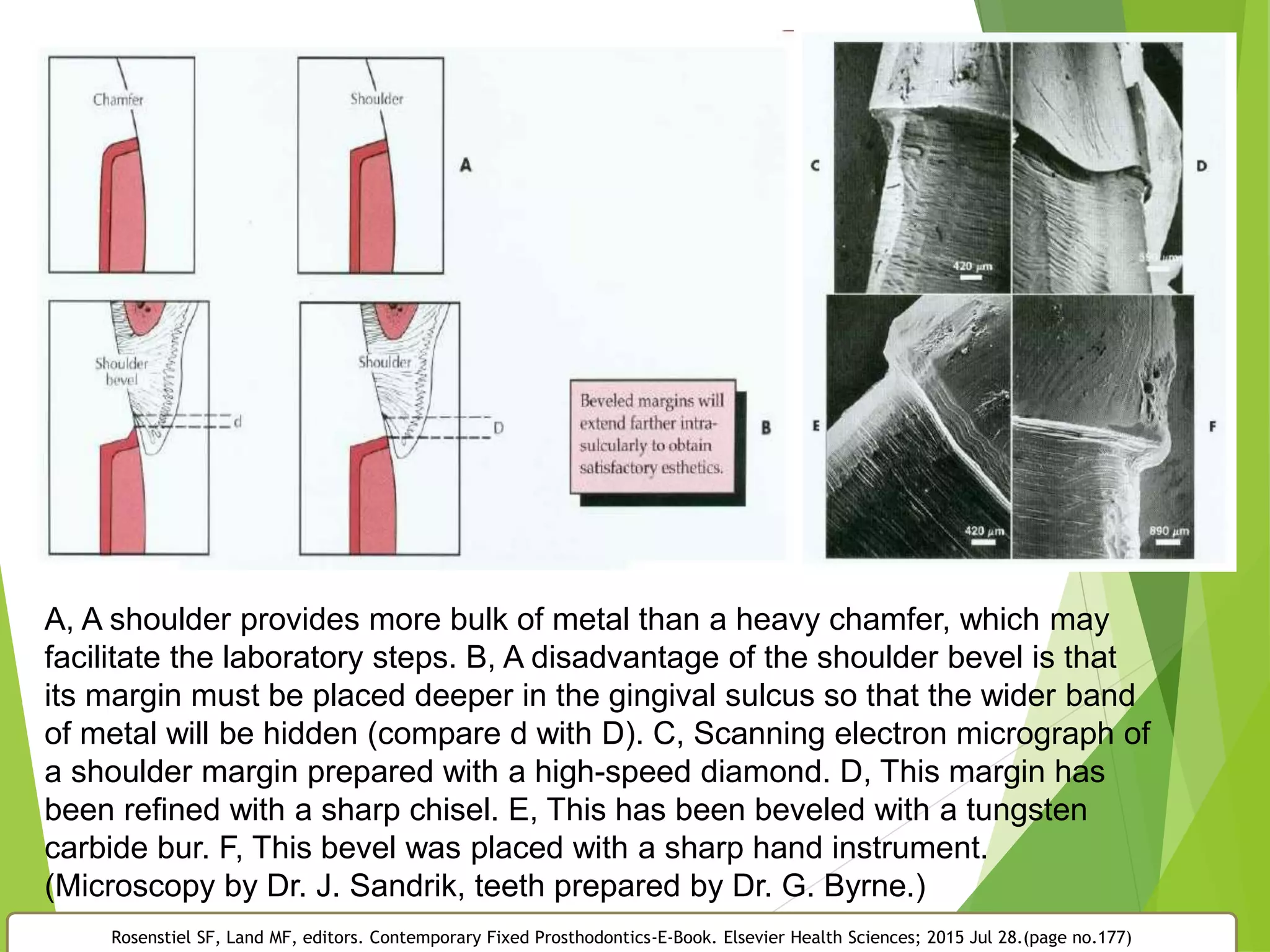 Gingival finish lines in fixed prosthodontics | PPT