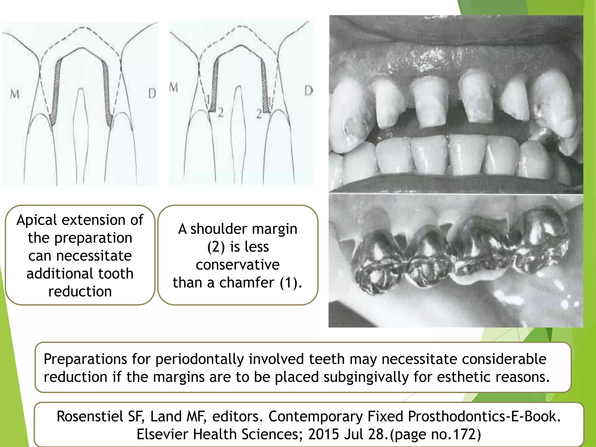 Gingival finish lines in fixed prosthodontics | PPT