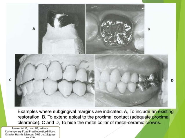 Gingival finish lines in fixed prosthodontics | PPT | Dental Health ...