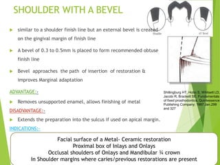Gingival finish lines in fixed prosthodontics | PPT