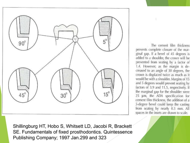 Gingival finish lines in fixed prosthodontics | PPT | Dental Health ...