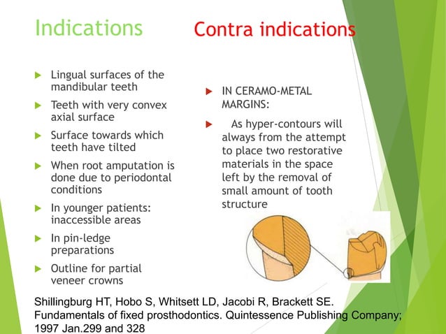 Gingival finish lines in fixed prosthodontics | PPT | Dental Health ...
