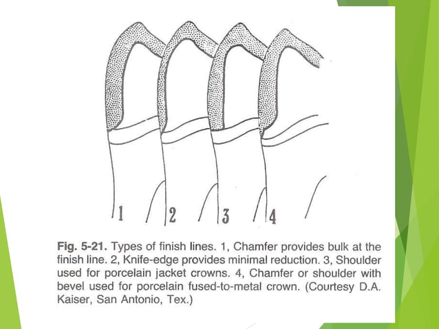 Gingival finish lines in fixed prosthodontics | PPT | Dental Health ...
