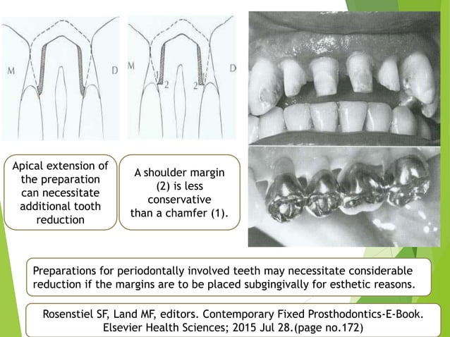 Gingival finish lines in fixed prosthodontics | PPT | Dental Health ...