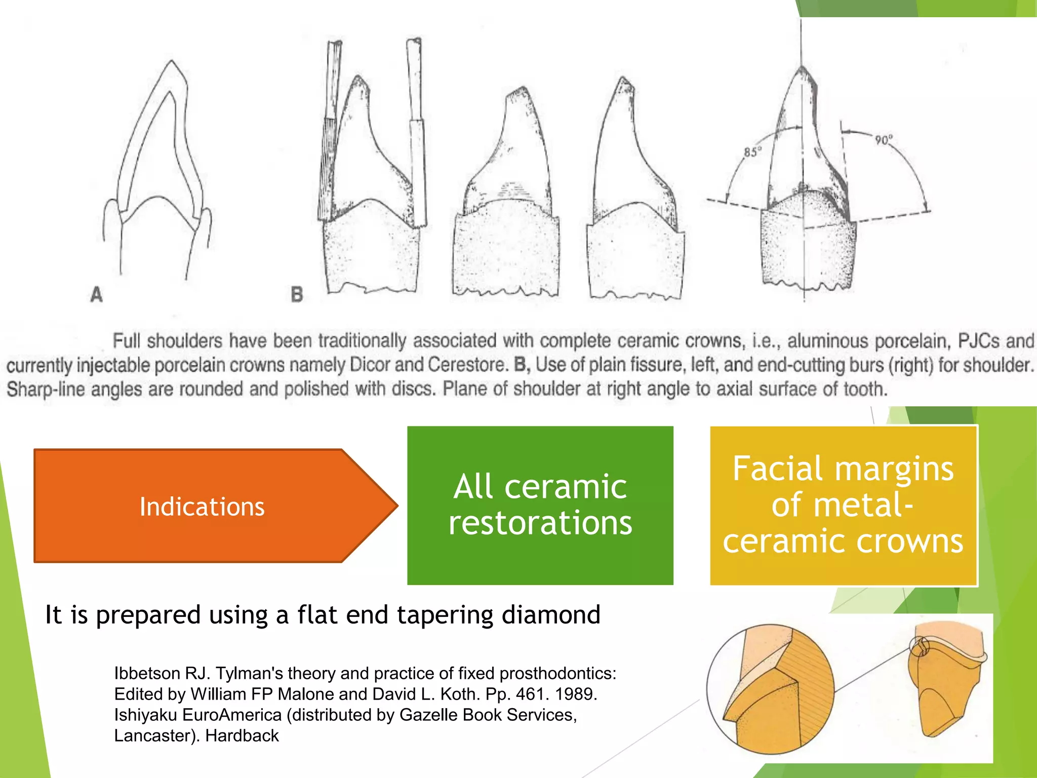 Gingival finish lines in fixed partial denture(FPD) with references | PDF