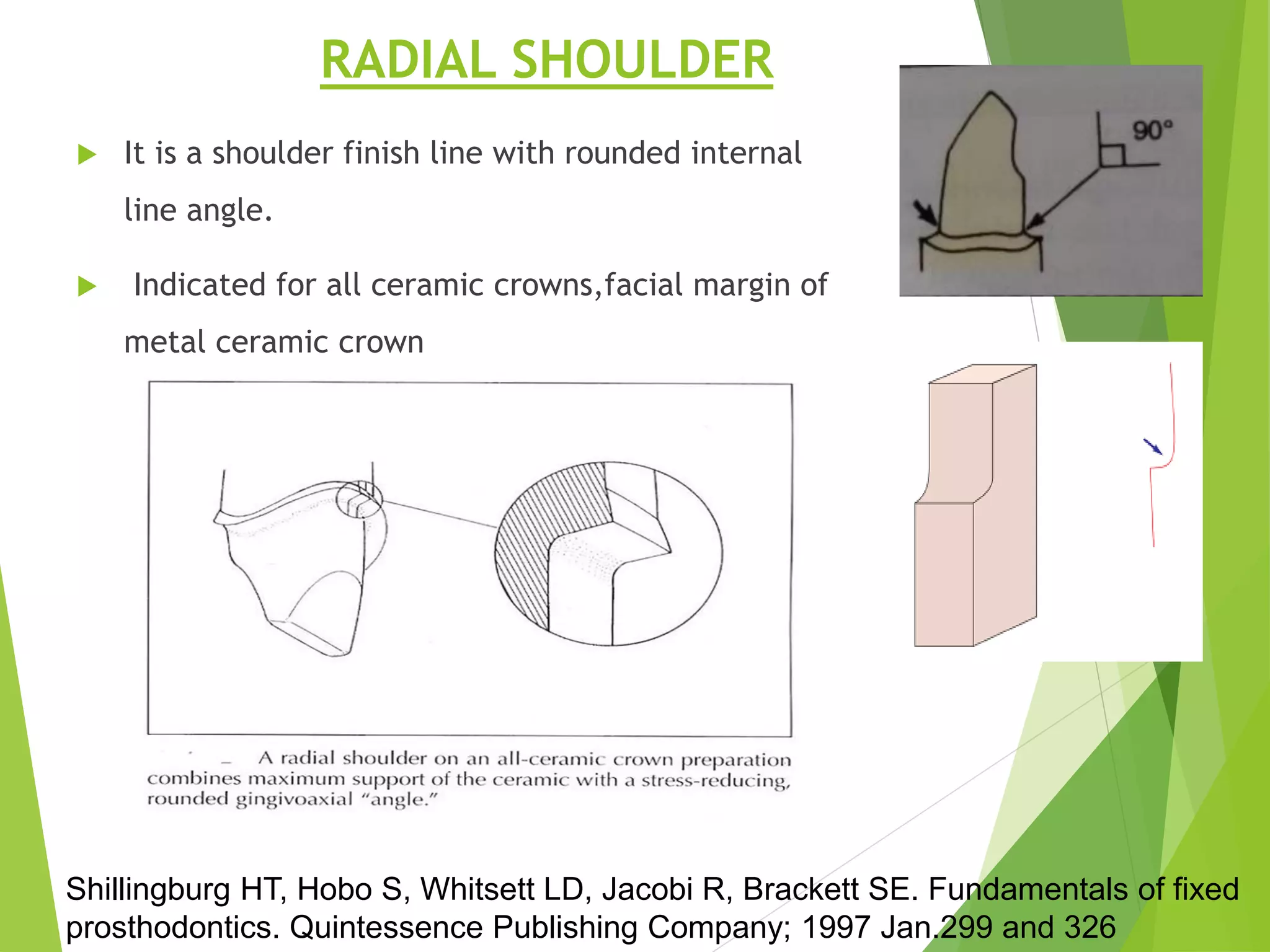 Gingival finish lines in fixed partial denture(FPD) with references | PDF