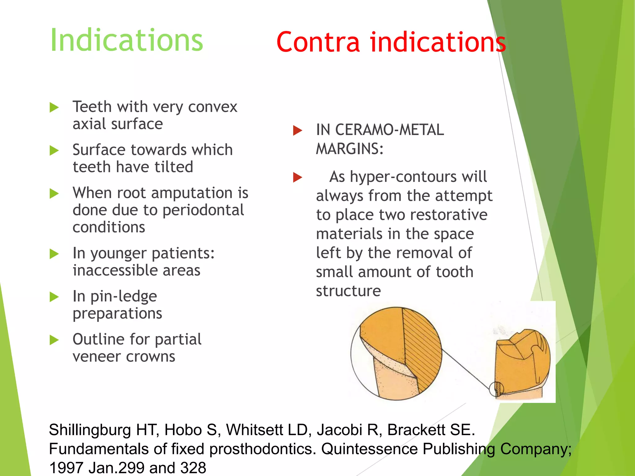Gingival finish lines in fixed partial denture(FPD) with references | PDF