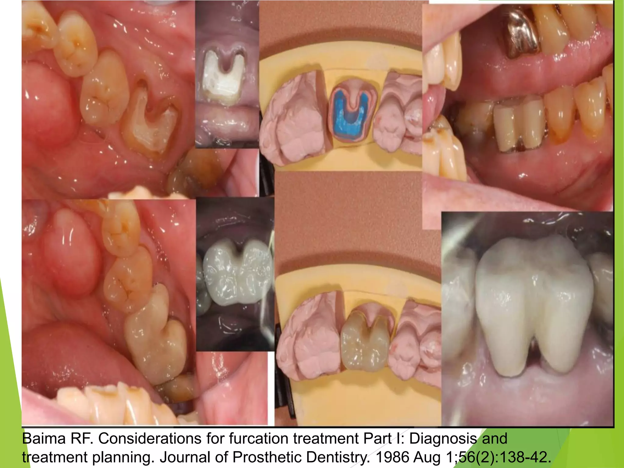 Gingival finish lines in fixed partial denture(FPD) with references | PDF