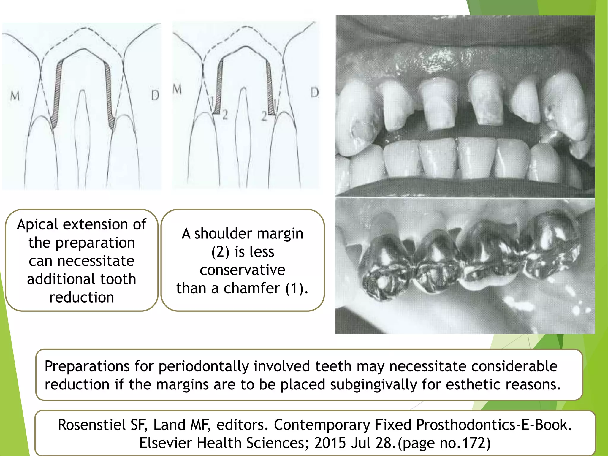 Gingival finish lines in fixed partial denture(FPD) with references | PDF