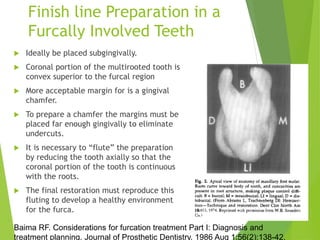 Gingival finish lines in fixed partial denture(FPD) with references | PDF