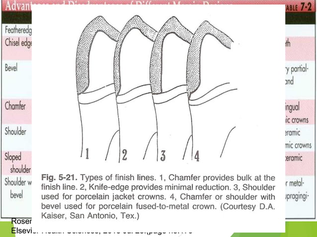 Gingival finish lines in fixed partial denture(FPD) with references | PDF