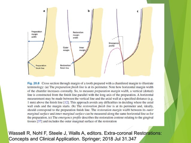 Gingival finish lines in fixed partial denture(FPD) with references | PDF