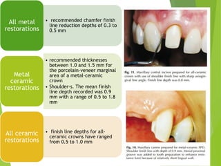 Gingival finish lines in fixed partial denture(FPD) with references | PDF