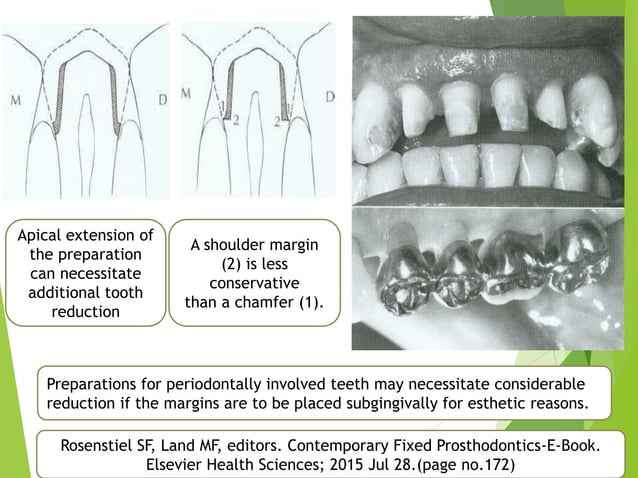 Gingival finish lines in fixed partial denture(FPD) with references | PDF