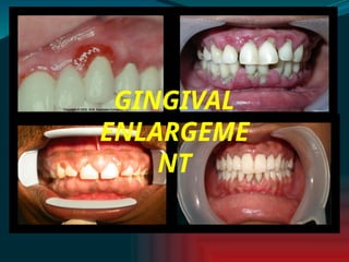 GINGIVAL HYPERPLASIA IN DENTISTRY PERIODONTOLOGY GINGIVAL ENLARGEMENT.pptx