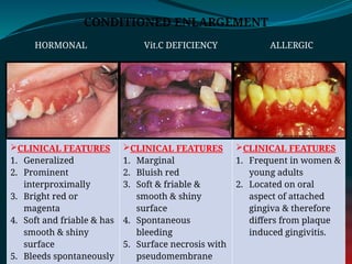 GINGIVAL HYPERPLASIA IN DENTISTRY PERIODONTOLOGY GINGIVAL ENLARGEMENT.pptx