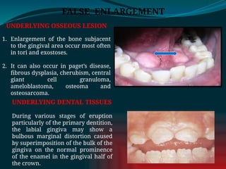 GINGIVAL HYPERPLASIA IN DENTISTRY PERIODONTOLOGY GINGIVAL ENLARGEMENT.pptx