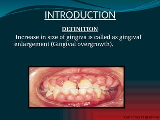 GINGIVAL HYPERPLASIA IN DENTISTRY PERIODONTOLOGY GINGIVAL ENLARGEMENT.pptx