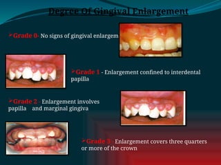 GINGIVAL HYPERPLASIA IN DENTISTRY PERIODONTOLOGY GINGIVAL ENLARGEMENT.pptx