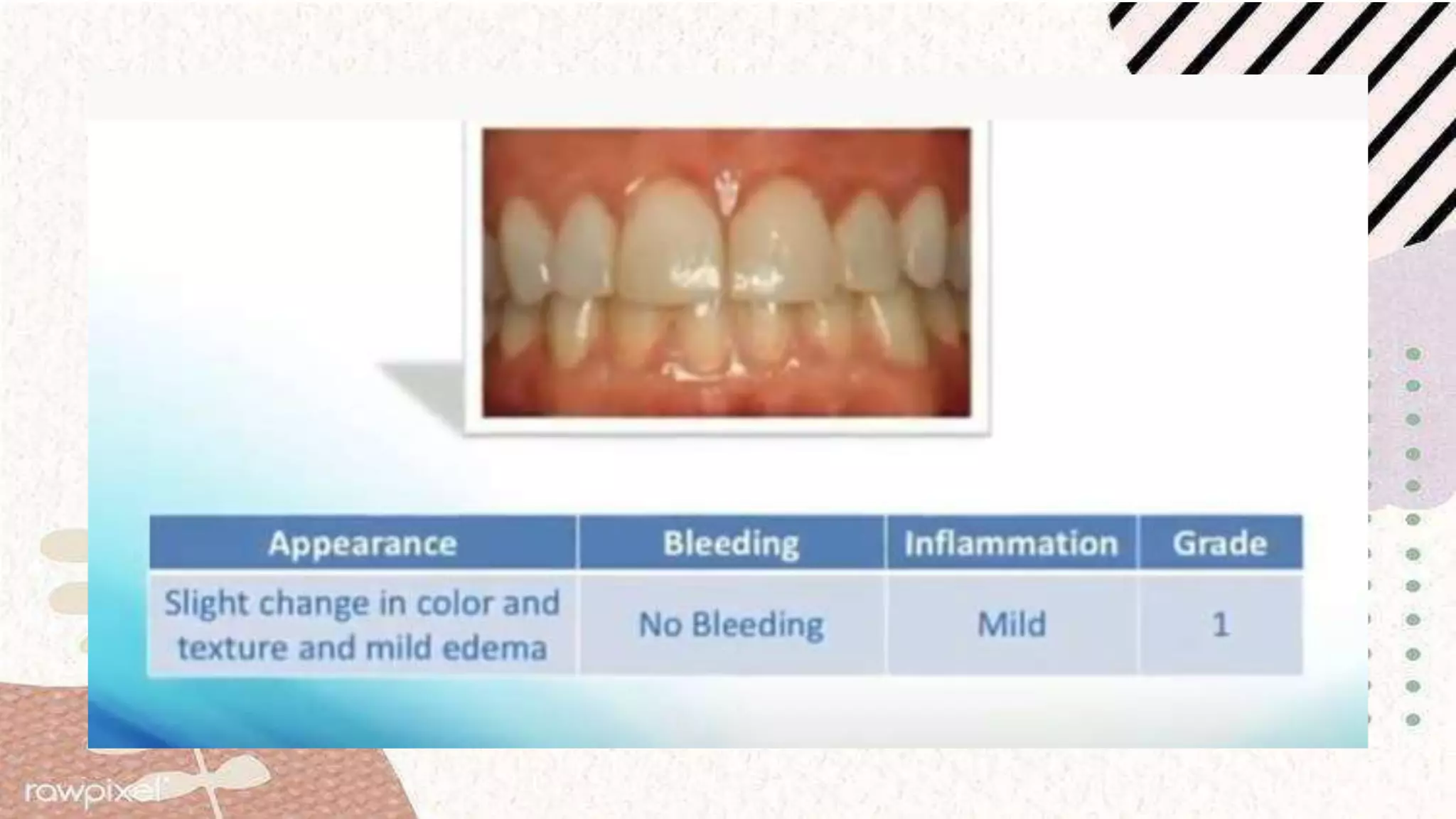 Gingival index.pptx