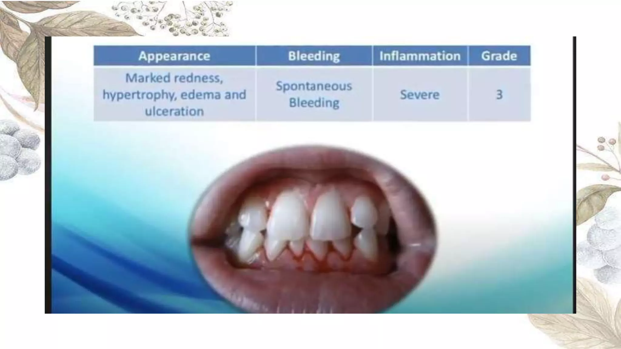 Gingival index.pptx