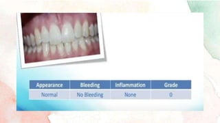 Gingival index.pptx