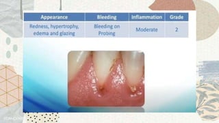 Gingival index.pptx