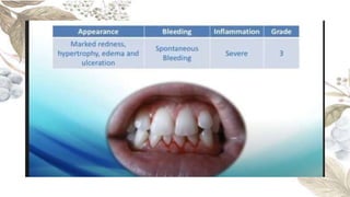 Gingival index.pptx