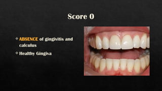 Gingival Index For Schoolchildren (GIS).pptx
