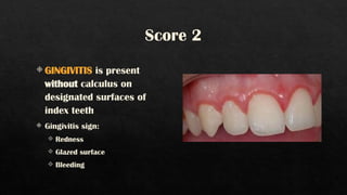 Gingival Index For Schoolchildren (GIS).pptx