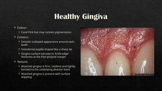 Gingival Index For Schoolchildren (GIS).pptx