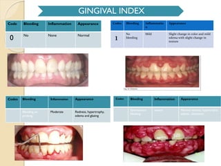 Gingival indexs | PPT