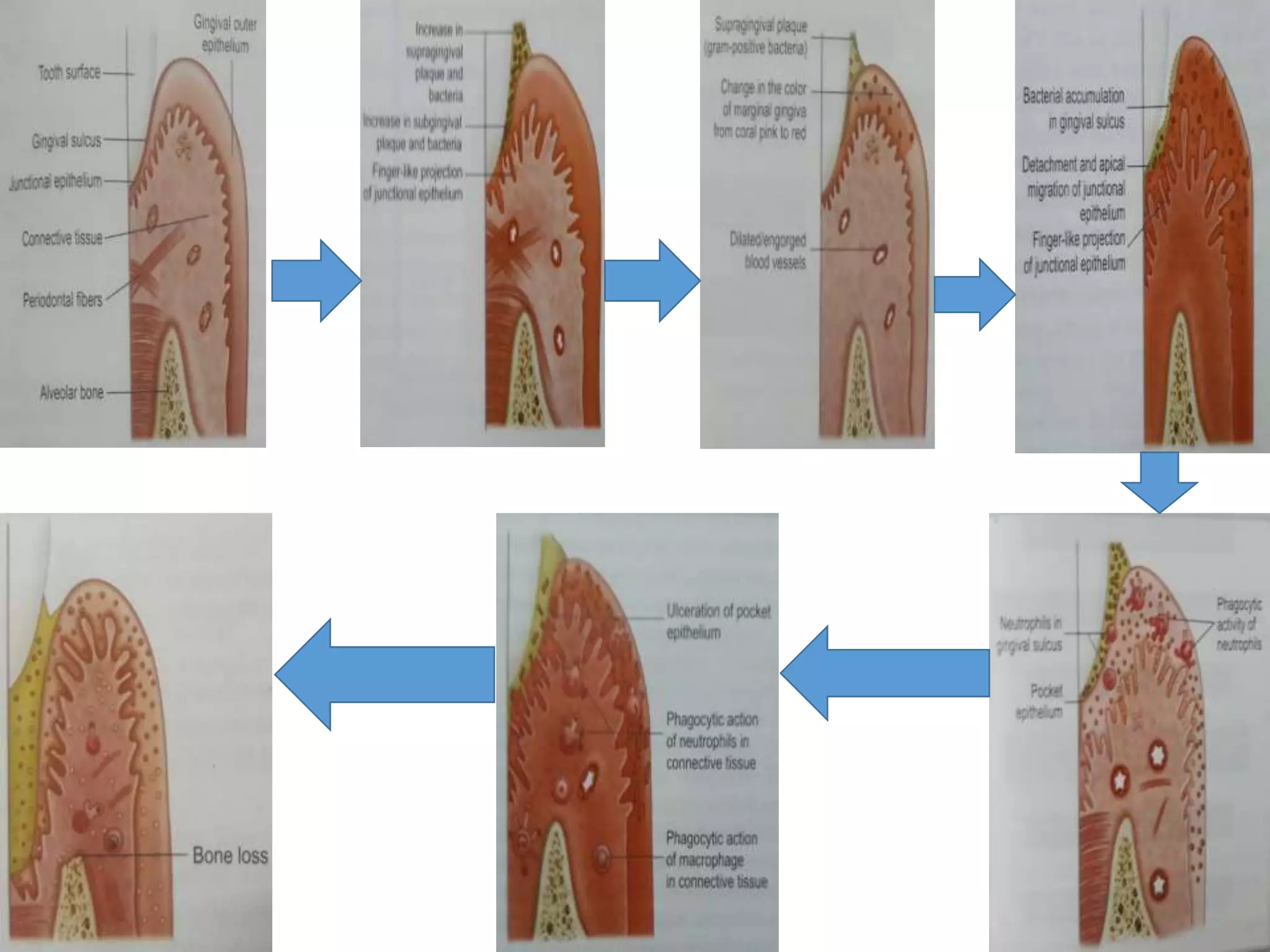 GINGIVAL INFLAMMATION | PPTX