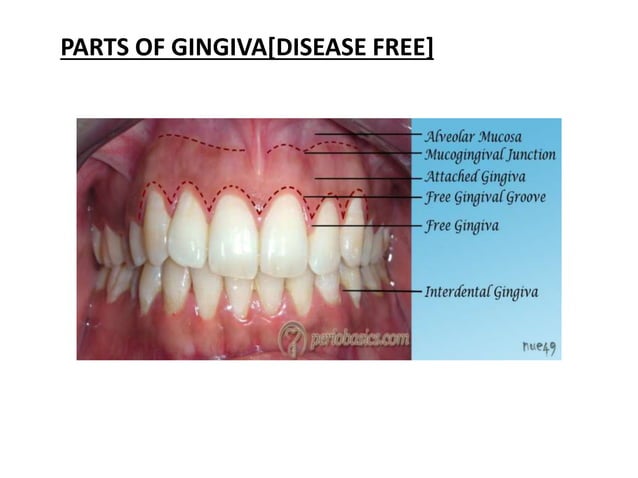 GINGIVAL INFLAMMATION | PPTX