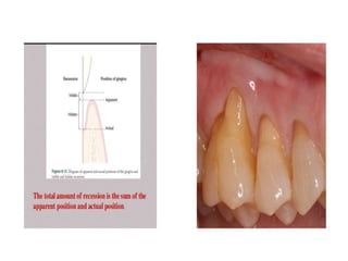 GINGIVAL INFLAMMATION | PPTX