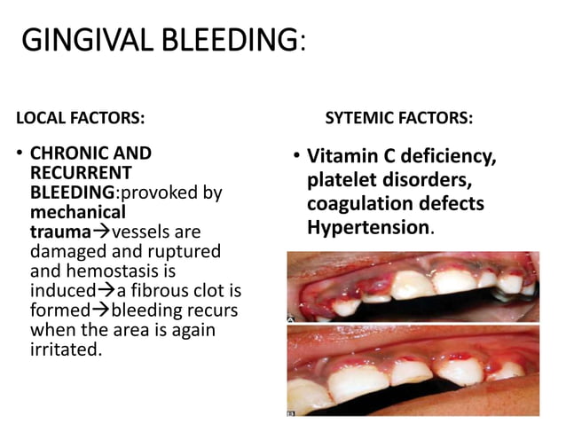 GINGIVAL INFLAMMATION | PPT