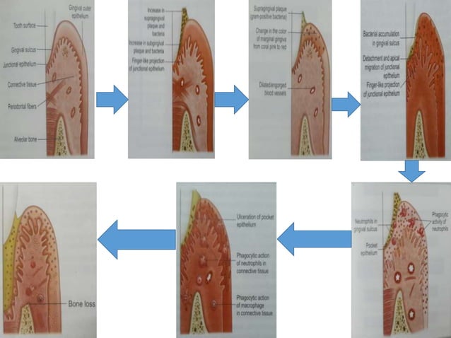 GINGIVAL INFLAMMATION | PPT