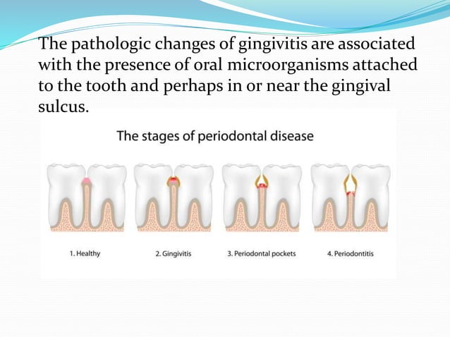 Gingival inflammation | PPTX