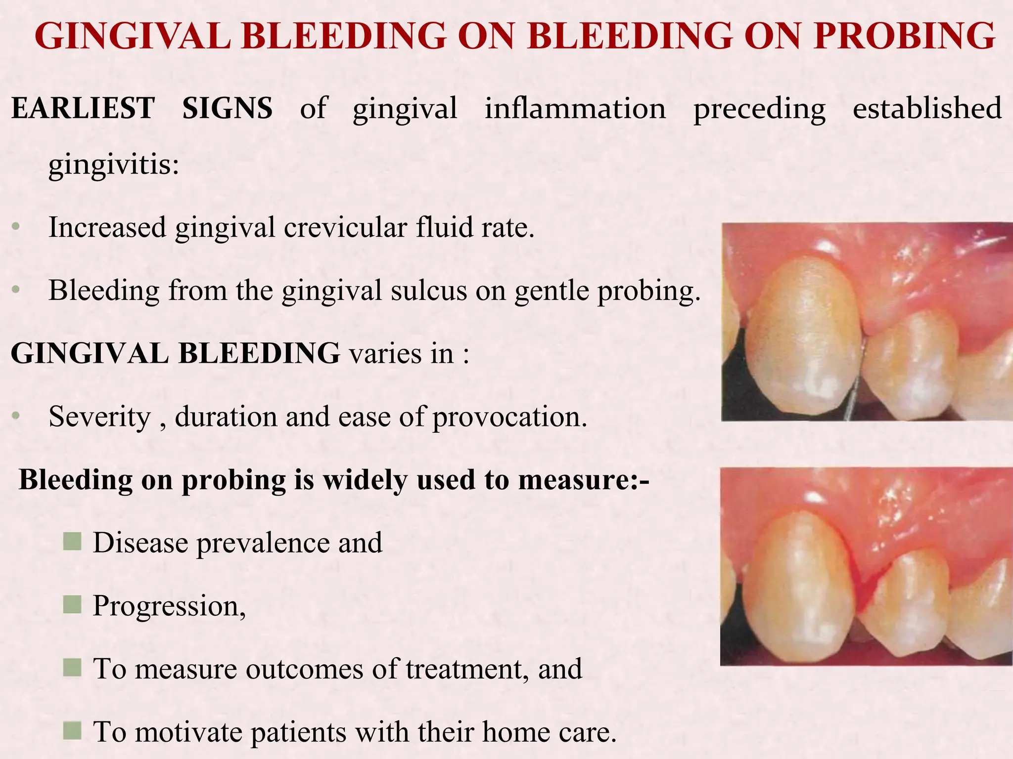 gingival inflammation.pdfczxcnzmxcnmxnccmz | PDF