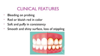 Gingival inflammation - Dr Smijal Gopalan Marath - Specialist ...